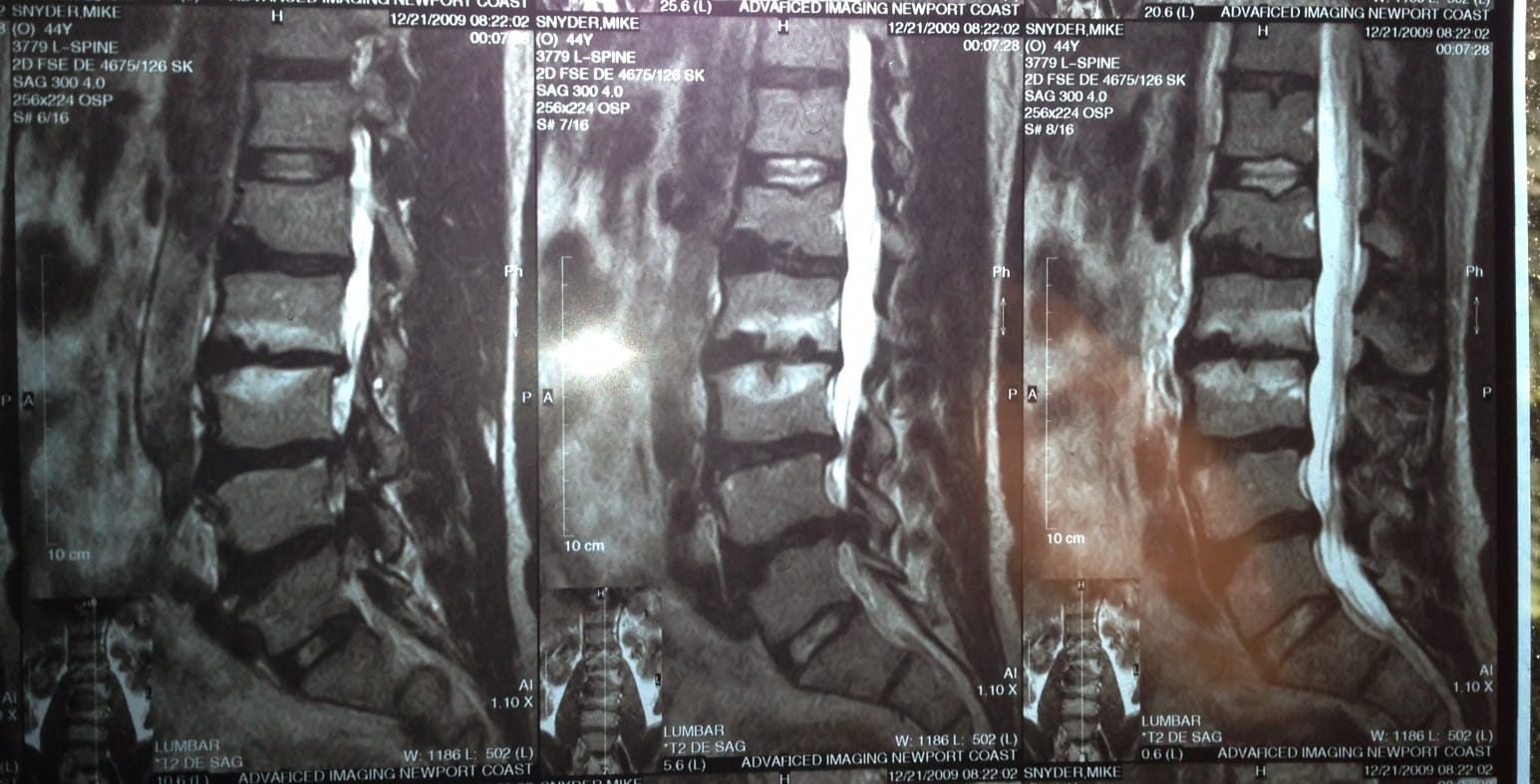 Herniated Disc Treatment - Dr. Mike Snyder, D.C. - Gonstead ...